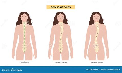 Female Jaw Deformities Of Mandibular Medical Poster Cartoon Vector