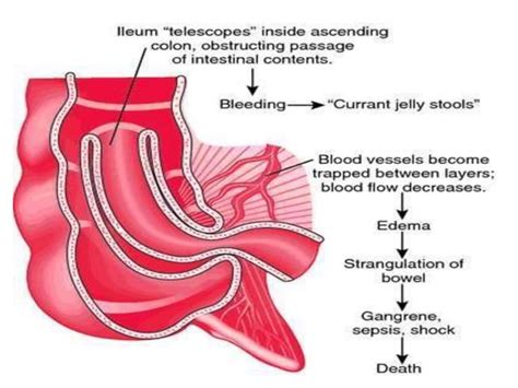 Intussusception Ppt
