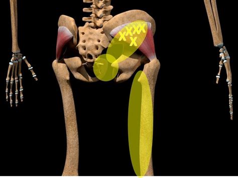 Acupuncture For Gluteus Minimus Trigger Points — Morningside Acupuncture Nyc