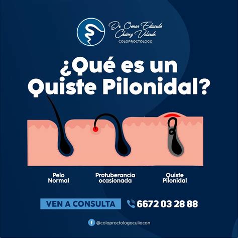 Dr 🔍 ¿qué Es Un Quiste Pilonidal 🔍 El Quiste Pilonidal Es Una