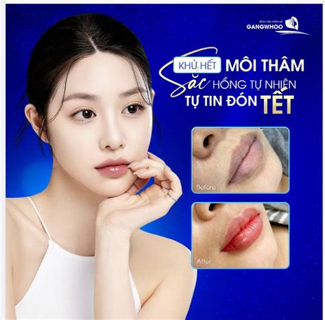 KhỬ HẾt MÔi ThÂm SẮc HỒng TỰ NhiÊn TỰ Tin ĐÓn TẾt CÙng Bvtm Gangwhoo