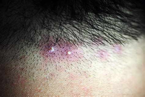 Folikulitis Kepala Ini Penyebab And Pengobatannya