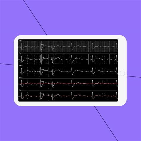 Case Computer Vision System For Ecg Analysis