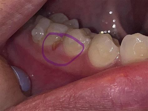 Cut On Gum Or Abscess Raskdentists