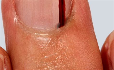 Subungual Melanoma Md Searchlight