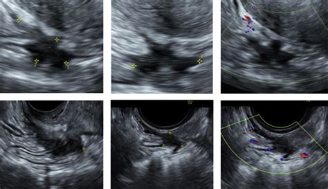 Ultrasound Imaging In Endometriosis Obstetrics And Gynecology Clinics