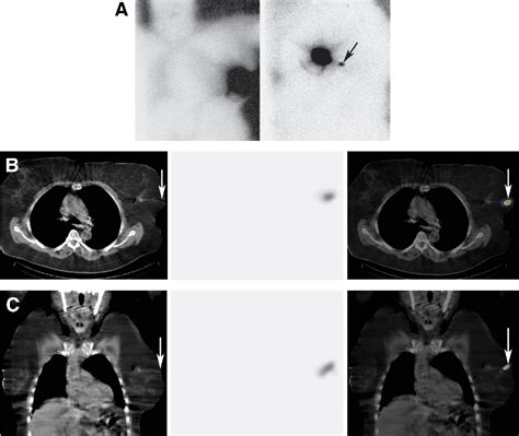 Figure 1 From Improved Sentinel Node Identification By Spectct In
