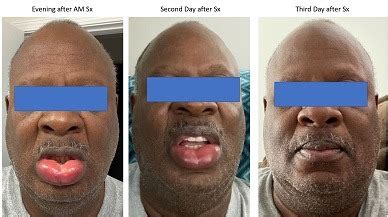 Wheaton Dental — Liver Clot After Dental Implant Surgery Wheaton