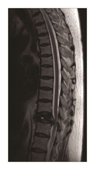 Illustrative Case Showing The Authors Surgical Technique Of Anterior