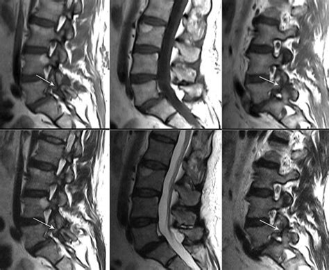 La Neuroimagen Espondilolisis Bilateral De L5 Con Espondilolistesis