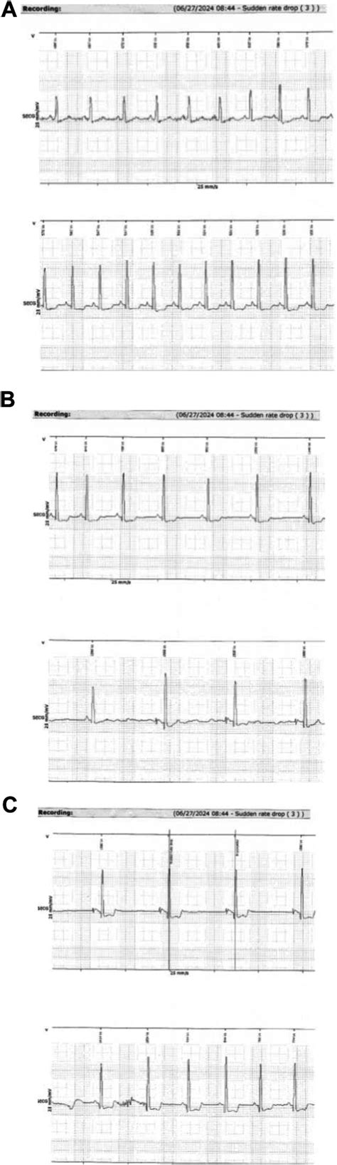 Vasovagal Syncope Successfully Treated With An Atrial Leadless