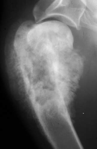 Musculoskeletal Radiology Aggressive Vs Benign Lesions Flashcards Quizlet