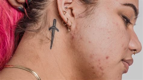 Hormonal Acne Jawline
