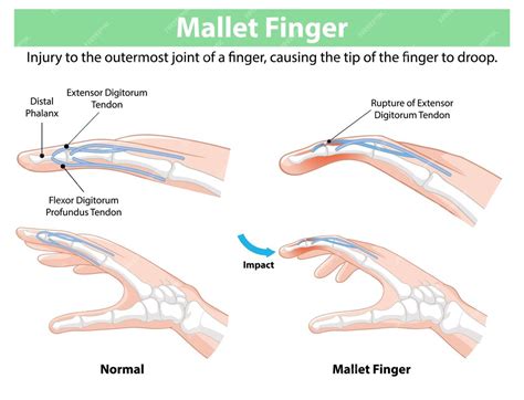 Free Vector Mallet Finger Injury Illustration