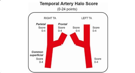 Diagram Demonstrating The Six Temporal Artery Segments For Calculating