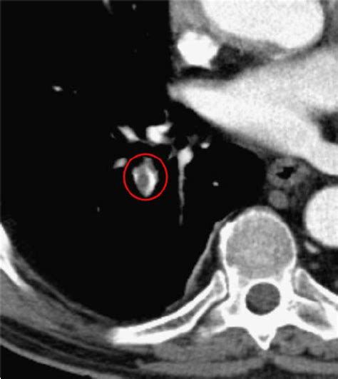 Filling Defect At The Segmental Level With A True Positive Marker From Download Scientific