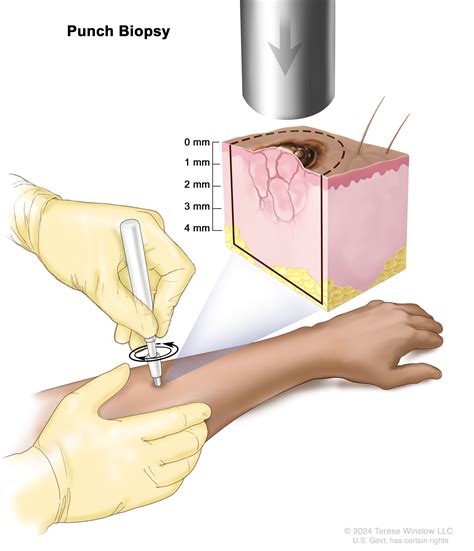 Melanoma Treatment Pdq®patient Version Siteman Cancer Center