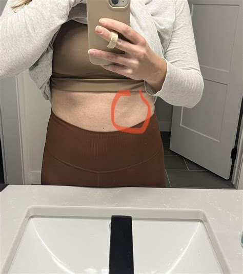 What Does An Ileostomy Hernia Look Like At Brad Hewitt Blog
