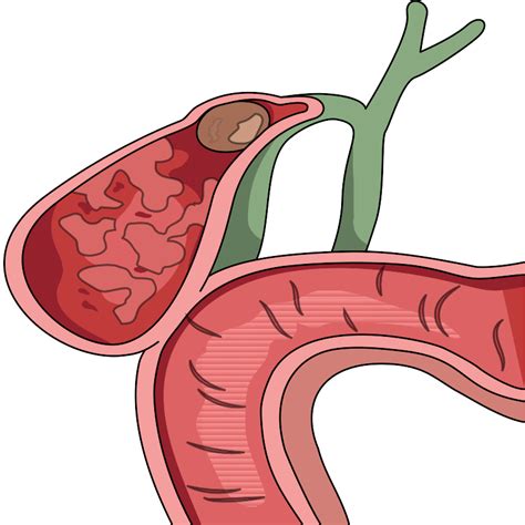 Gallstone In Gallbladder Cut Figure Science Figures
