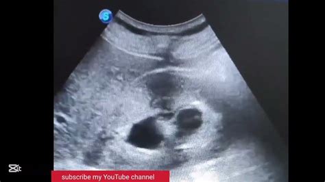 Obstruction Hydronephrosis With Renal Calculushydronephrosis