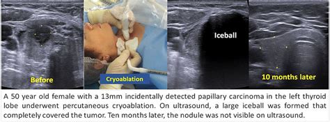 Cryoablation Thyroid Goiter