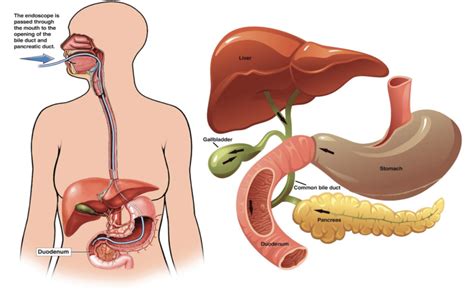 Ercp In Ashok Vihar Dr Anando Sengupta