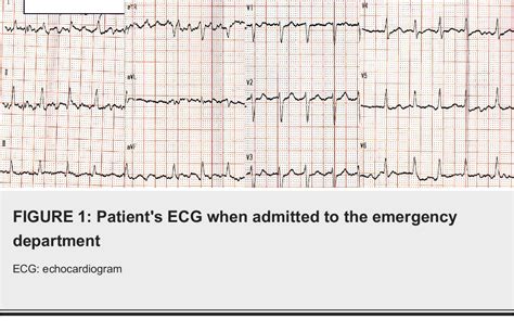 Atrial Flutter Ecg