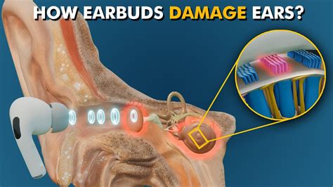 Earbuds Damage Ears At Alejandra Henning Blog