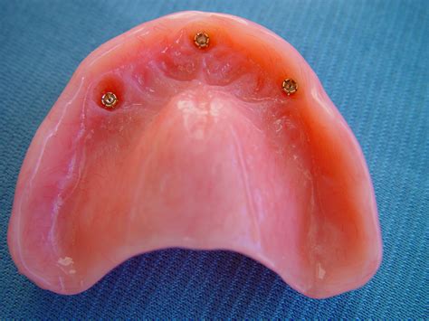 Implant Dentures Complete