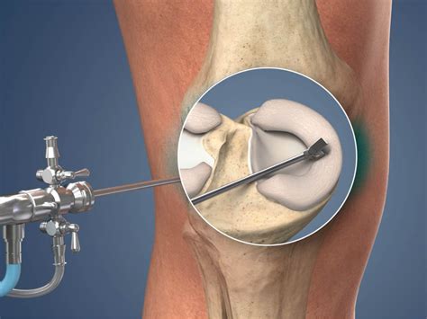 Recovery Tips For Patients Undergoing Meniscus Surgery Dr Saurabh Giri