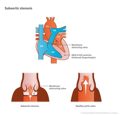 Cardiology Aortic Stenosis As
