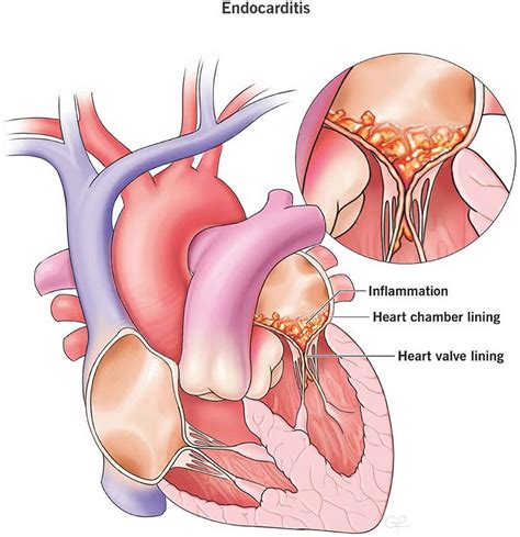 Infective Endocarditis Causes Signs Symptoms Diagnosis Treatment And Prognosis