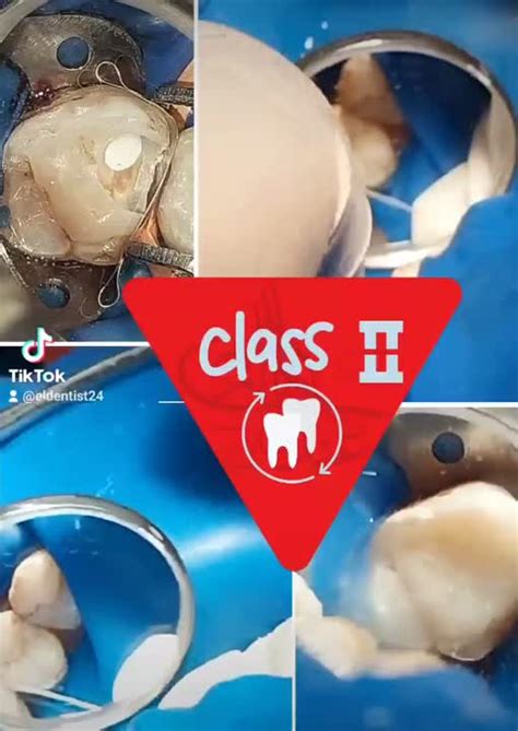 Abdullah Hatem On Linkedin Cl Ll Composite Restoration 🤤