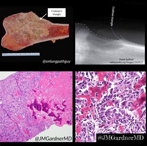 Osteosarcoma Codman Triangle Jerad Gardner Md