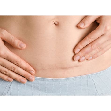 How Do I Massage My C Section Scar — Pivot Osteopathy