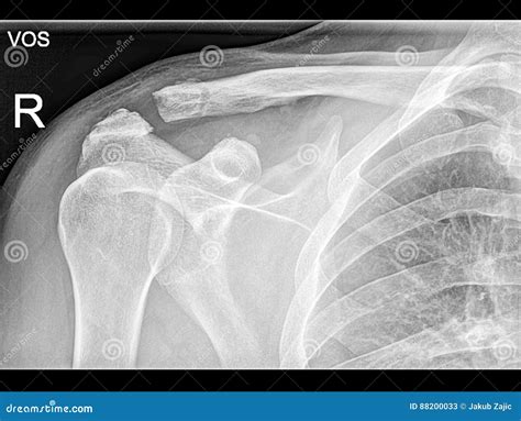 Broken Clavicle Bone Fixation Fracture Repair Stock Image Image Of