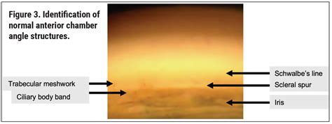 Gonioscopy Anatomy