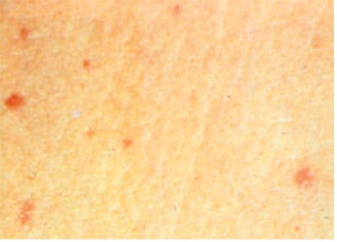 Enteric Fever Orris Ai