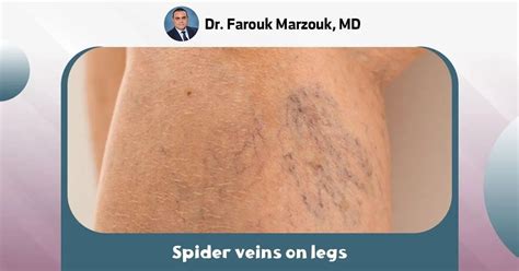 Spider Veins On Legs Specialist Care In Brooklyn Ny