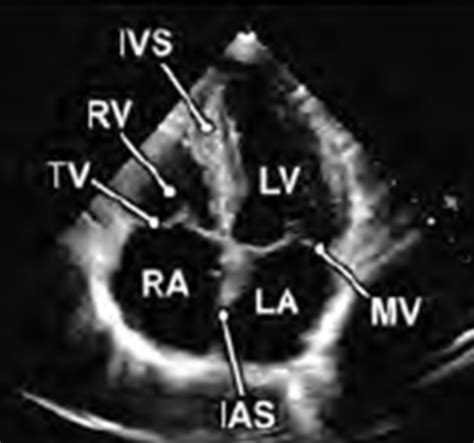 Lesson 12 Apical Window Imaging Flashcards Quizlet