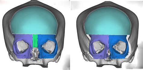 Orbital Box Osteotomies For Wide Spaced Eyes Or Eyes That Are Too Close