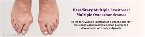 Exostoses Multiple Non Cancerous Bone Tumors Causes Symptoms Diagnosis And Treatment