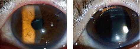 A Case Of An Asymptomatic Intralenticular Foreign Body Pmc