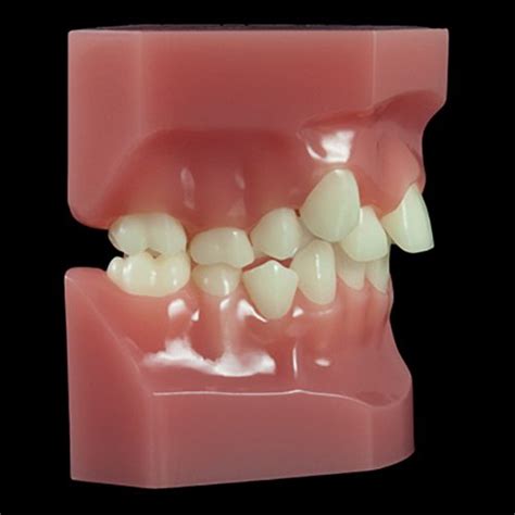 Or 17m Mixed Dentition Class Ii Division 1 Blocked Cuspid Flexibase