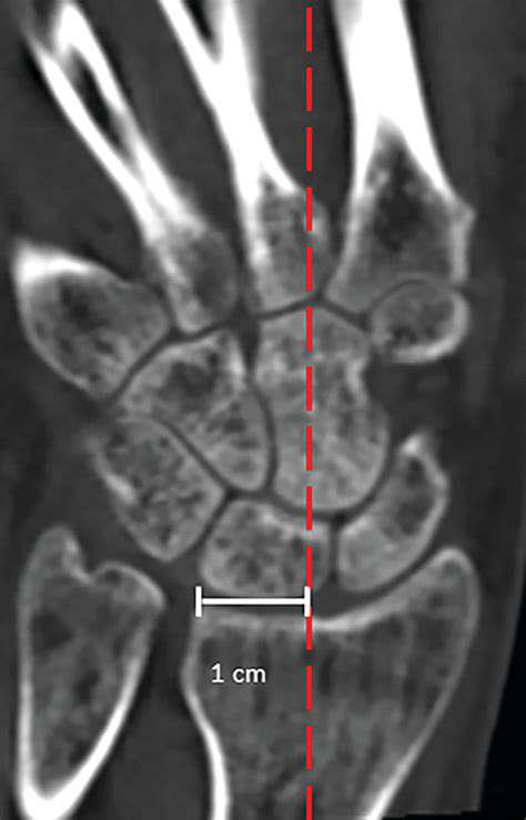 Scaphoid X Ray Angle