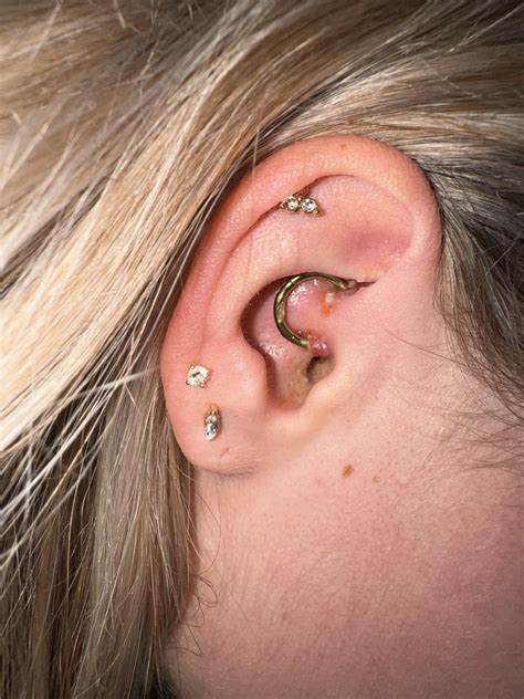 Infected Daith Piercing Rpiercingadvice