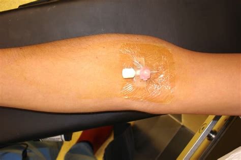 Tendinites Du Coude Épicondylite Et épitrochléite Pr Eric Roulot