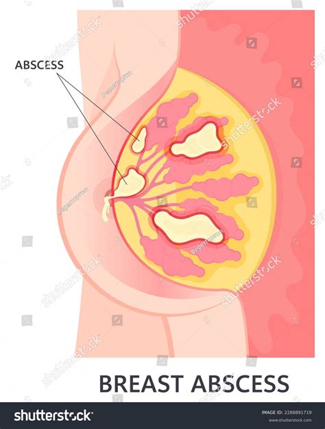 Breast Abscess Cancer Mastitis Engorgement Pregnancy Stock Vector