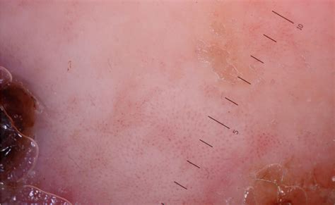 Dermoscopy Glomerular Vessels Download Scientific Diagram