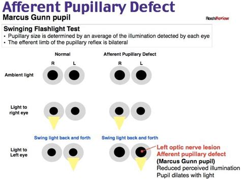 Afferent Pupillary Defect 1simspupils And Cranial Nerves